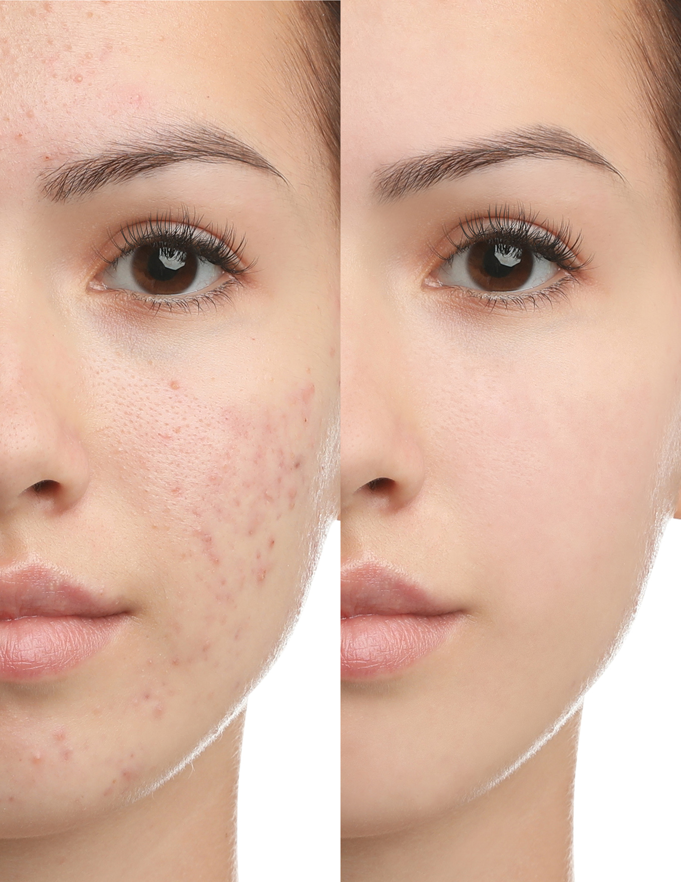 Acné y marcas de acné - Dra. Alicia Echeverría