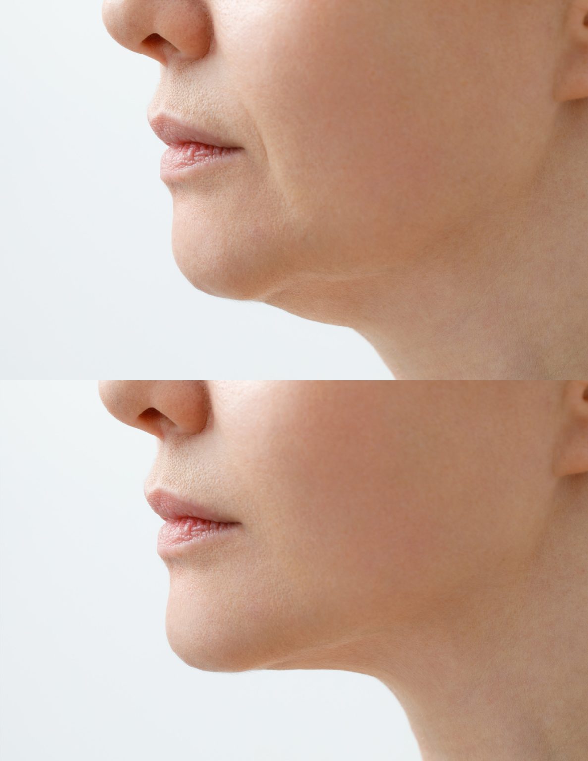 Aumento del mentón con ácido hialurónico - Dra. Alicia Echeverría