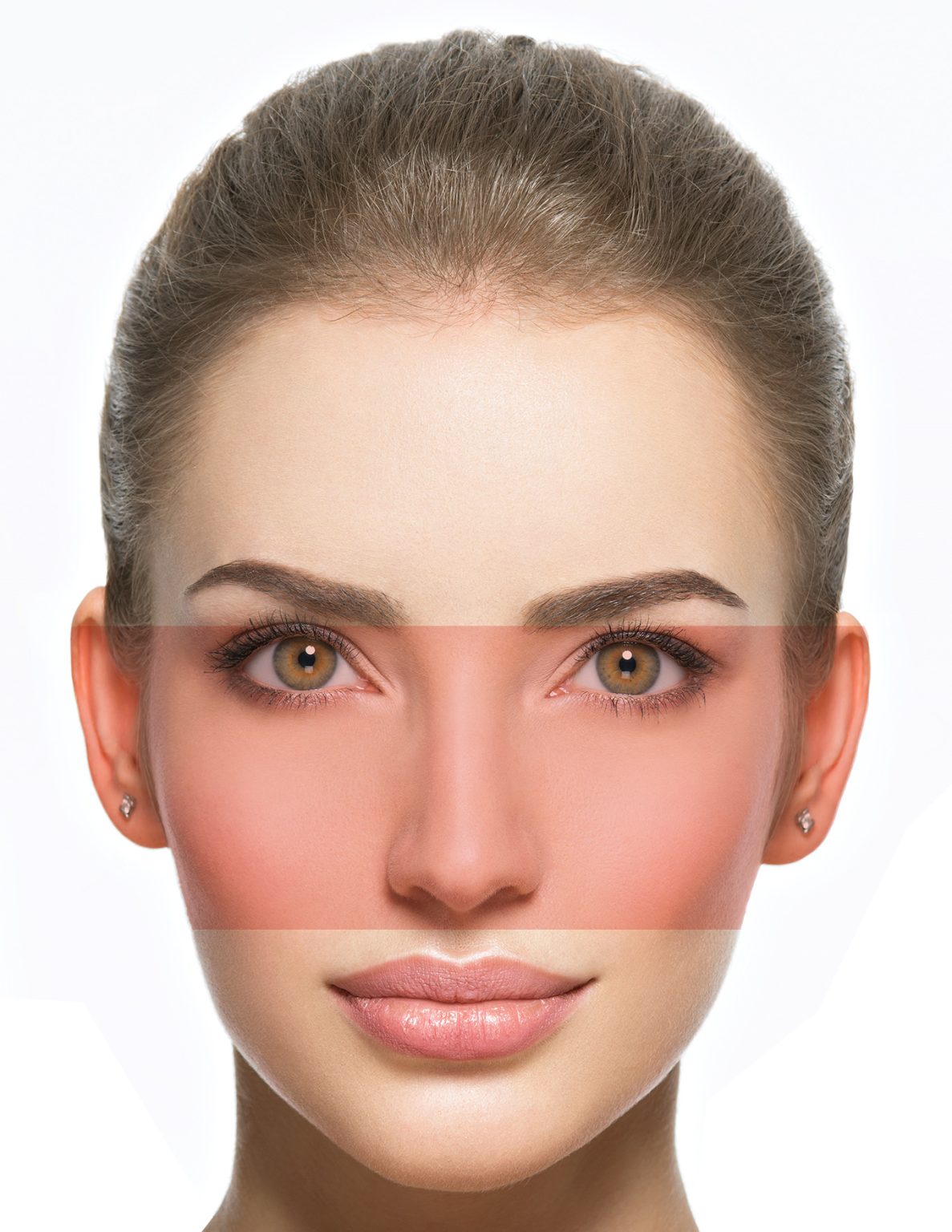 Faciales - Tercio medio - Dra. Alicia Echeverría