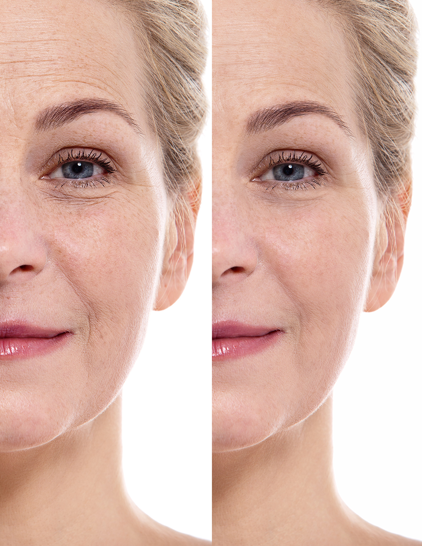 Flacidez facial - Dra. Alicia Echeverría
